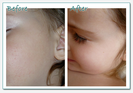 ba-face - Eczema Treatment and Care